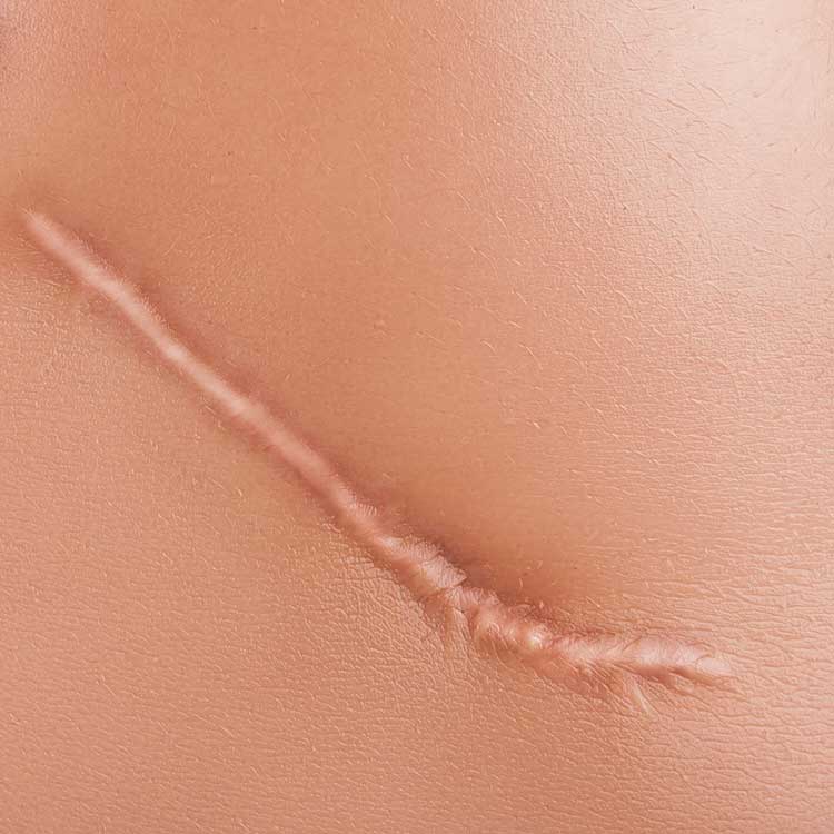 Scar Revision - The Banwell Clinic