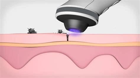 Beautify your skin, Shower your skin with Plasma - The Banwell Clinic