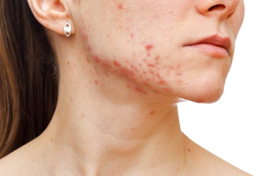 Dealing with Adult Acne - The Banwell Clinic